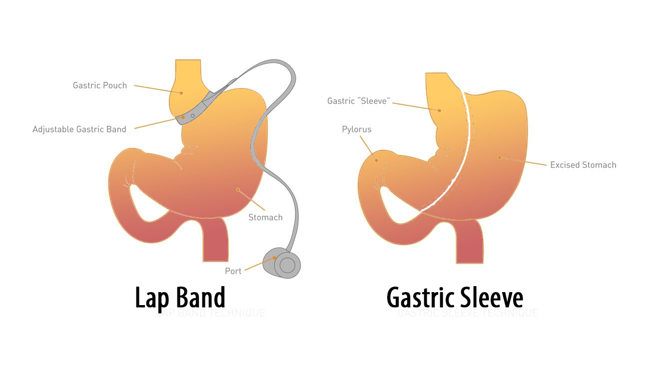 Lap Band Surgery How It Works Weight Loss Surgery Lap Band Surgery How It Works Weight Loss Surgery