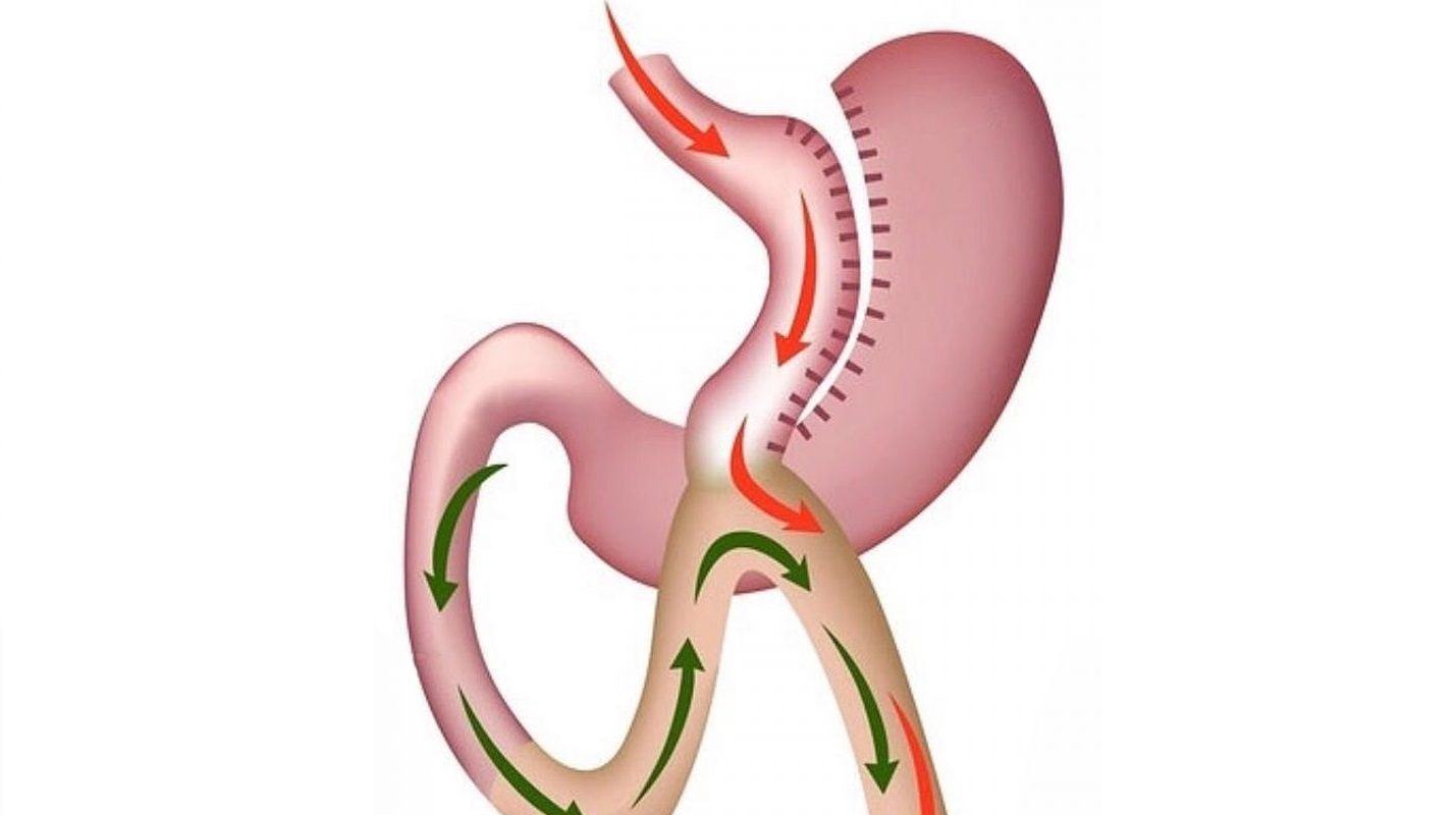 Mini Gastric Bypass Archives Weight Loss Surgery Information