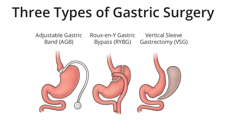8 Gastric Surgery Types to Choose - Weight Loss Surgery